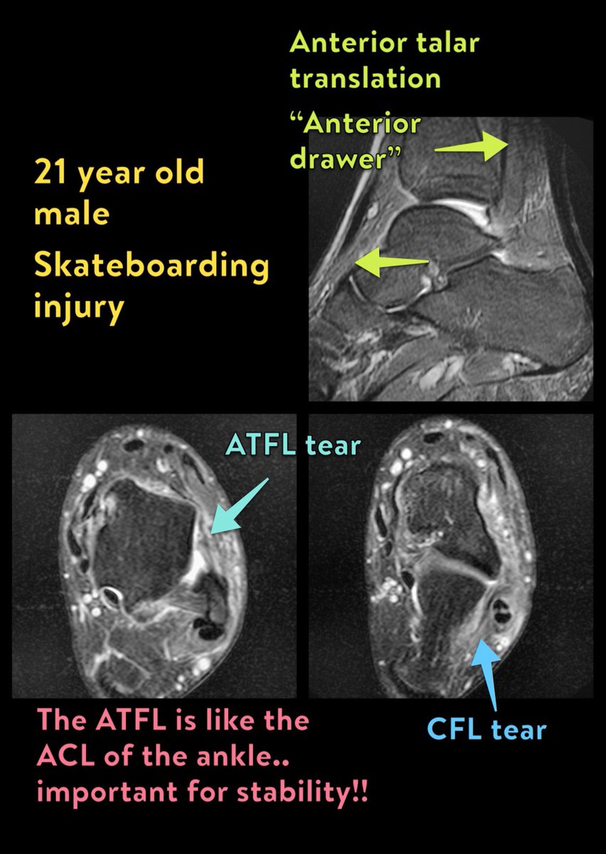 Anterior Tibiofibular Ligament Mri MRI Musculo Skeletal Section: High