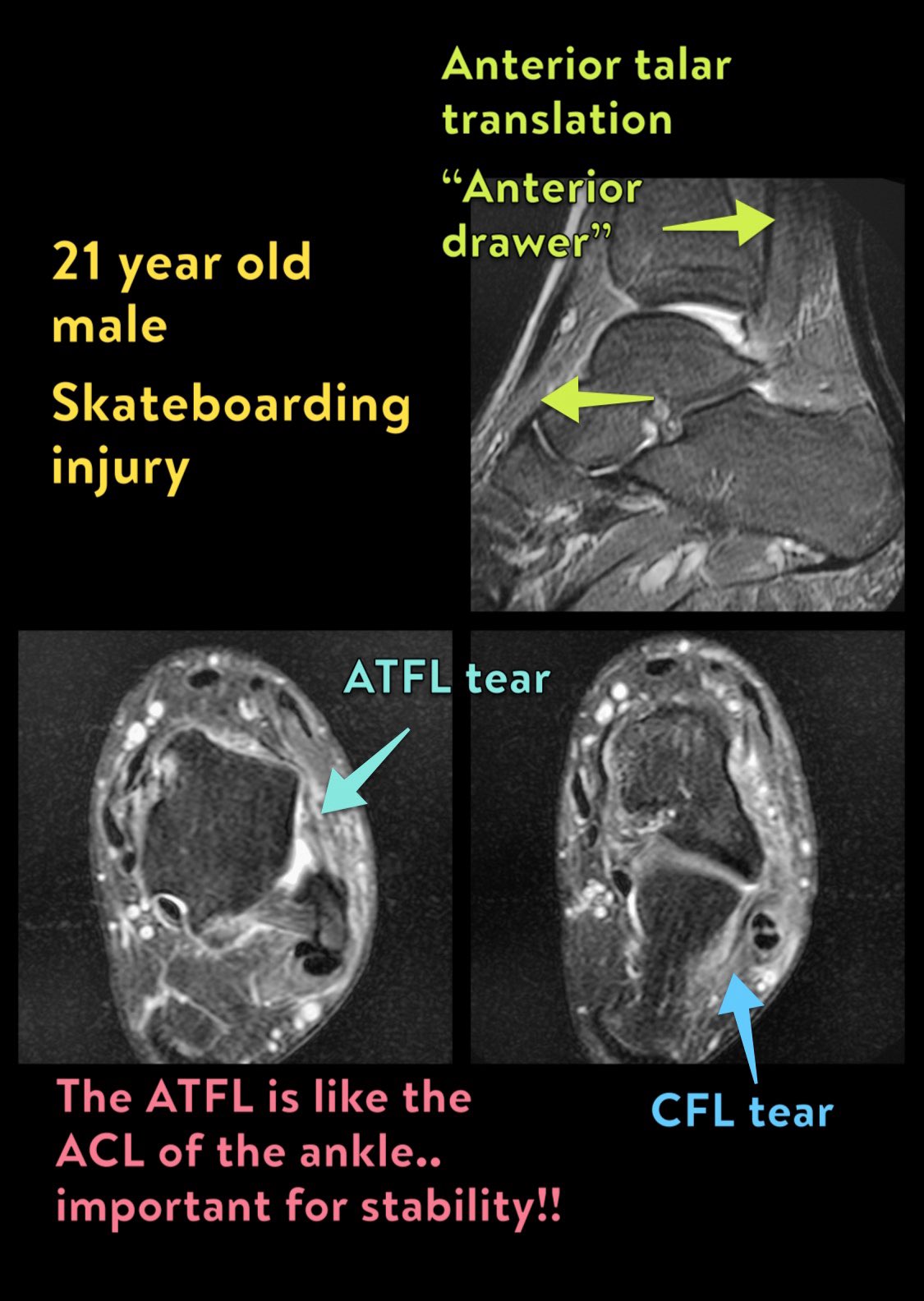 Calcaneofibular Ligament Mri