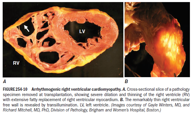 Arrhythmogenic Right Ventricular Dysplasia Histology