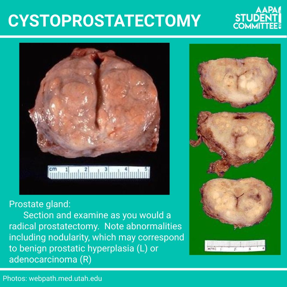 Benign Prostatic Hyperplasia Gross
