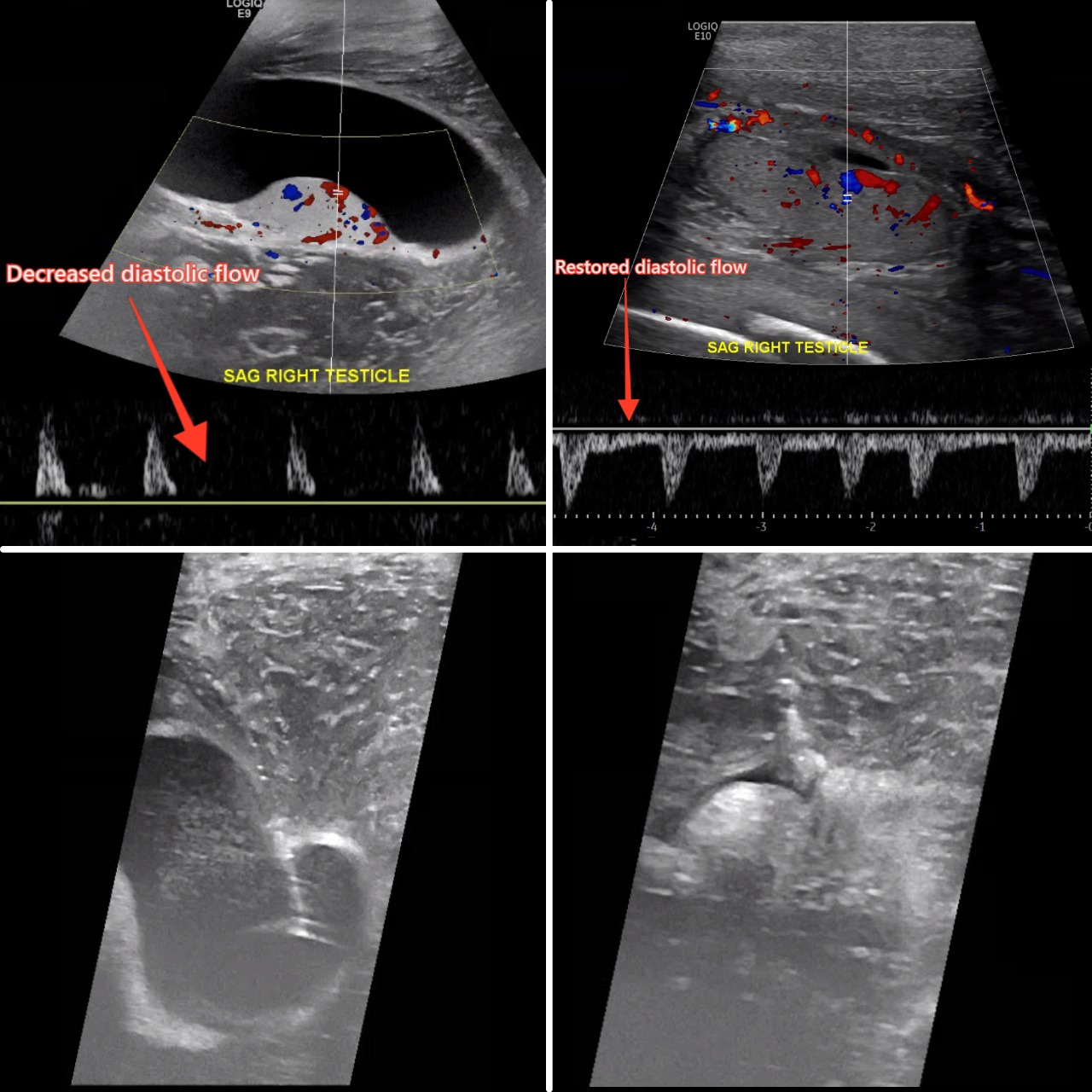 Hydrocele Ultrasound
