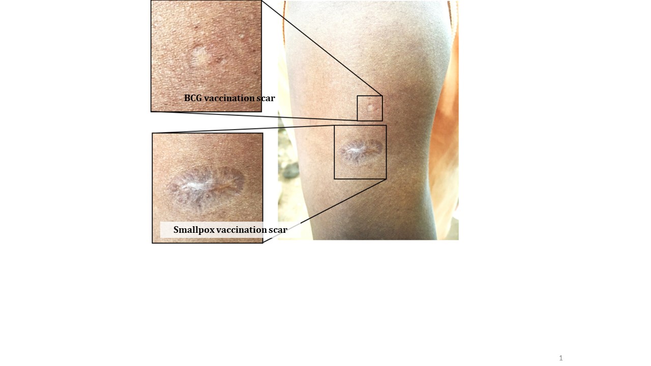 Smallpox Shot Scars