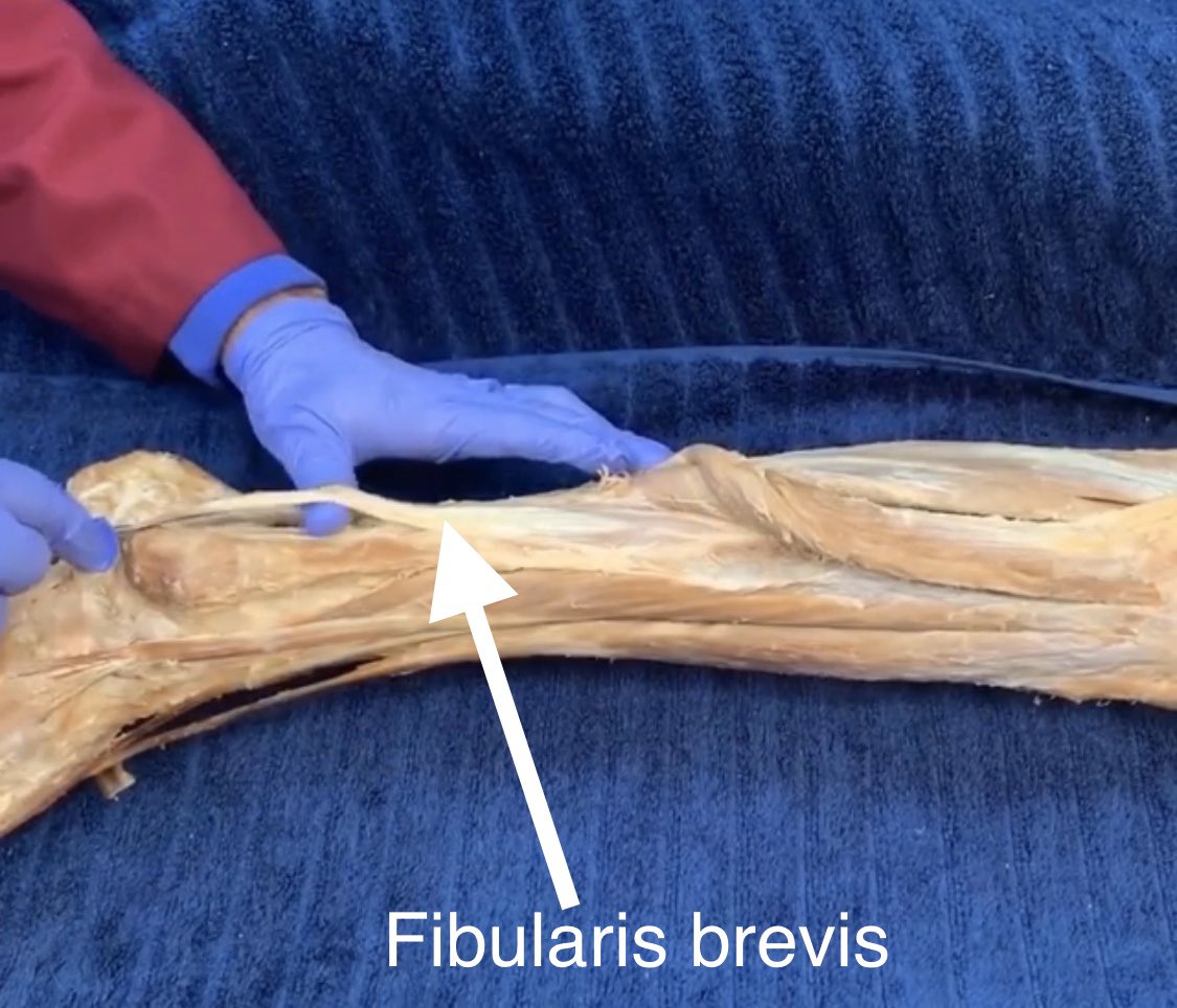 Peroneus Tertius Cadaver