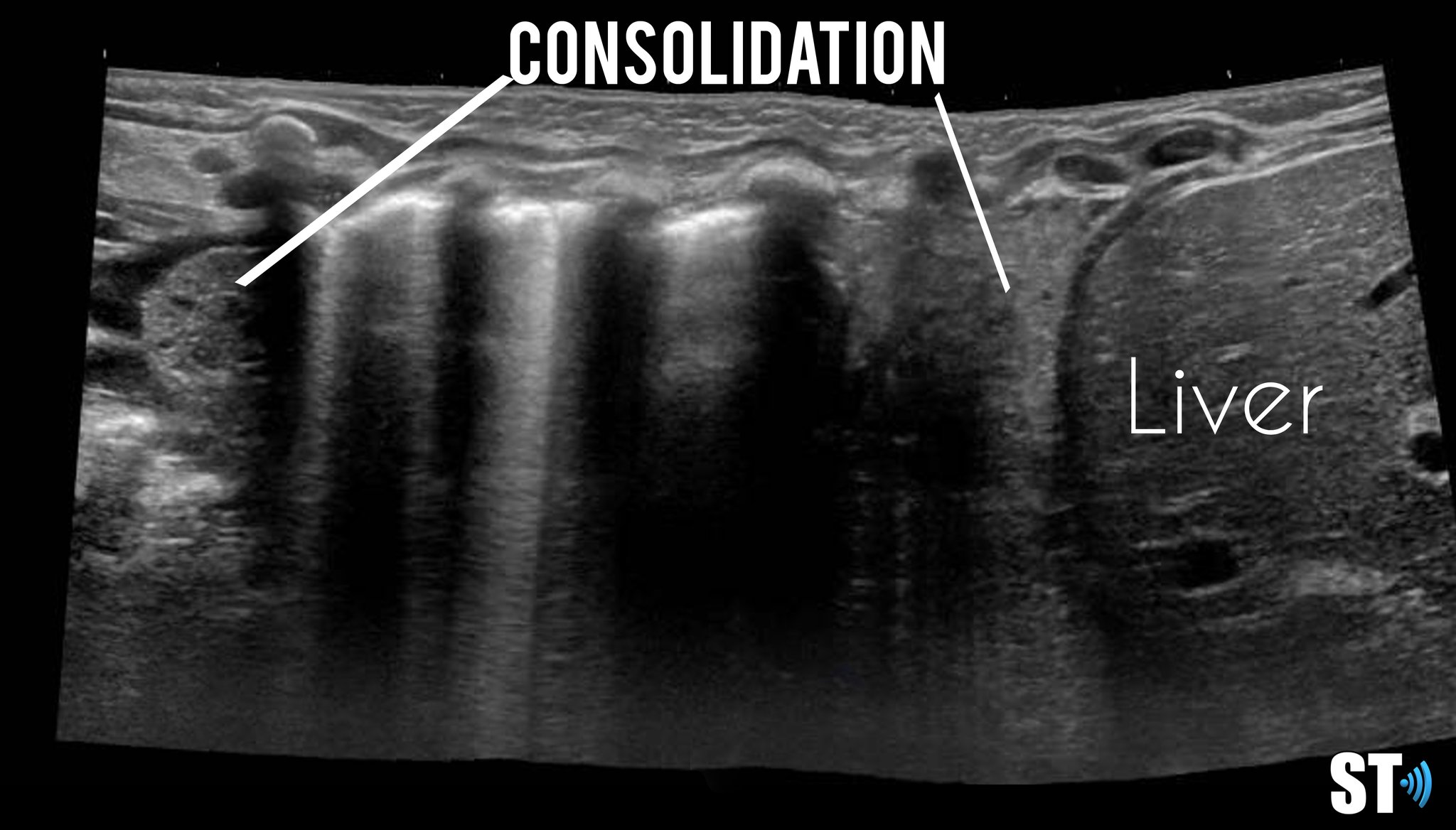 Hepatization Of Lung
