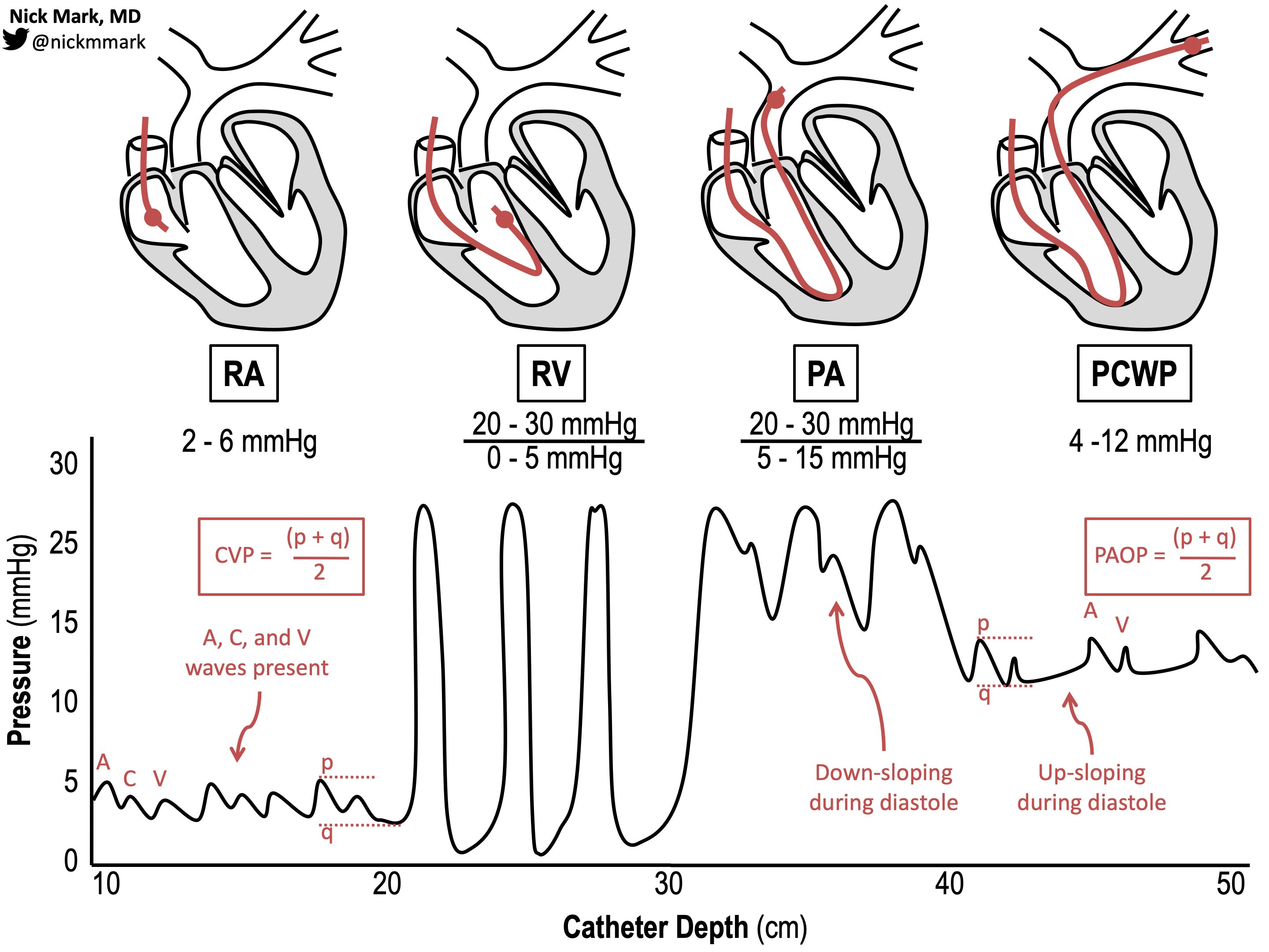 Pulmonary Artery Catheter Waveforms