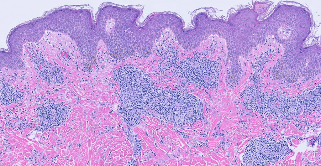 Erythema Chronicum Migrans Pathology