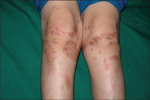 Scleroderma Skin Rash
