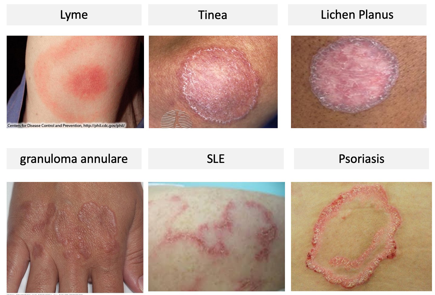 Antibiotics For Uncomplicated Skin Abscesses After Incision, 51% OFF