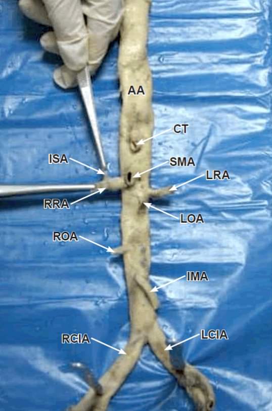 Celiac Trunk Cadaver