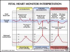 Variable Decelerations Basic Pattern Recognition – Electronic Fetal