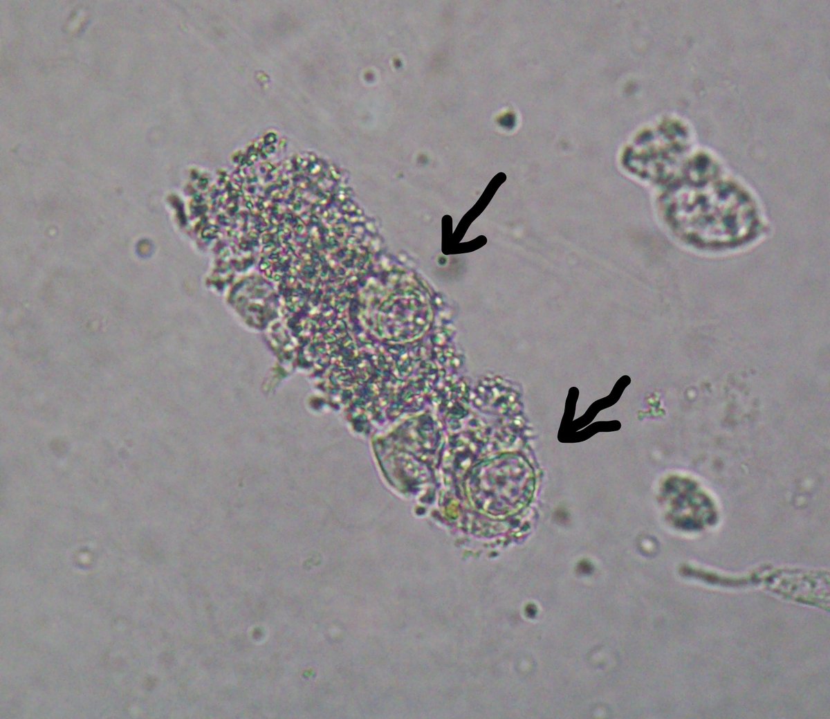Granular Casts In Urine