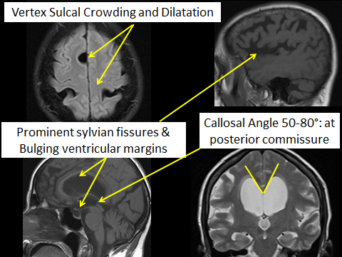 Posterior Commissure Mri