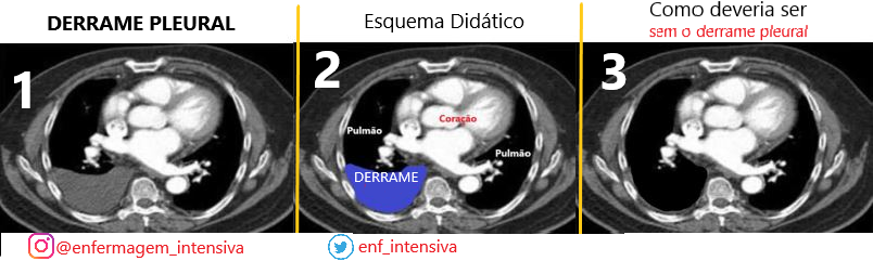DERRAME PLEURAL, dropped image link, RCC: Dr. Weber: Sarah L. Campos;…