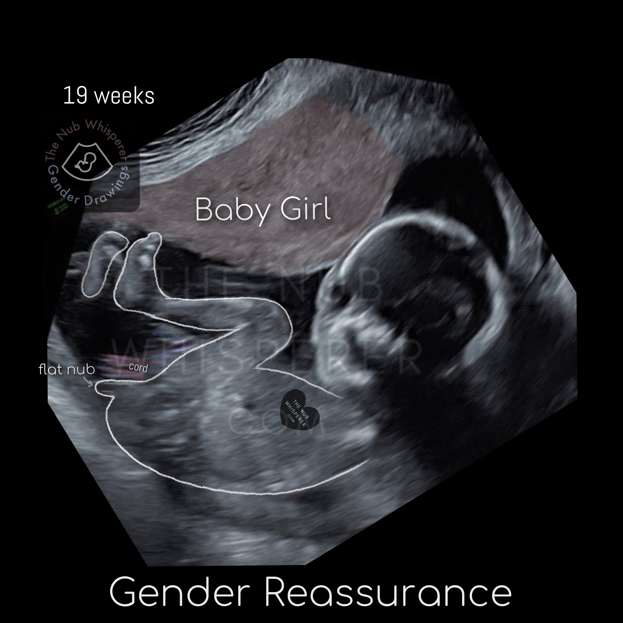 24 Weeks Ultrasound Gender