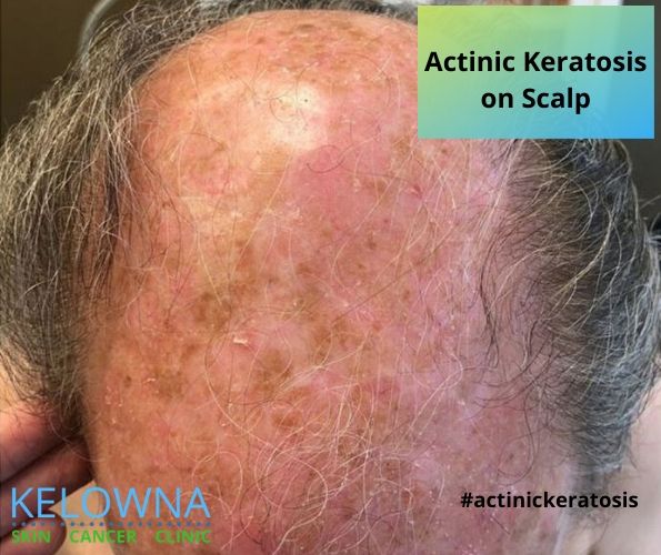 Actinic Keratosis On Scalp