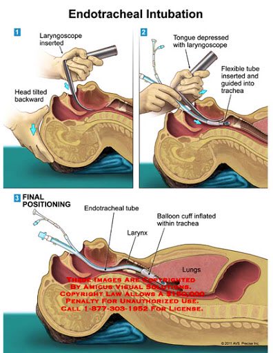 Endotracheal Intubation Video