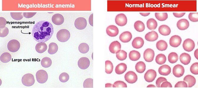 Folate Deficiency Smear