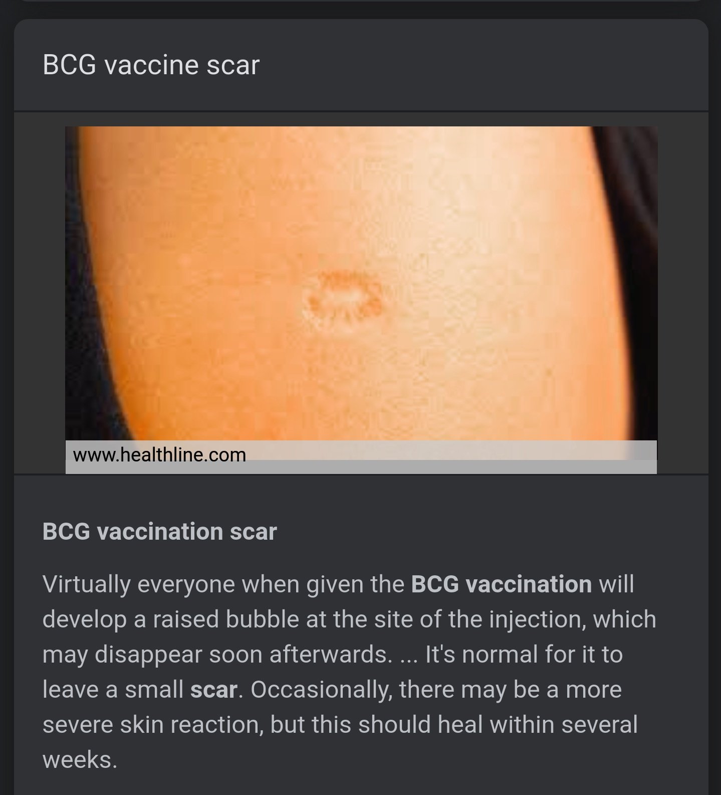Bcg Vaccine Scar Vs Smallpox Scar 19 Smallpox Scars Stock Photos,