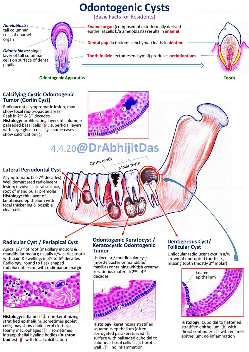 Lateral Periodontal Cyst Histology