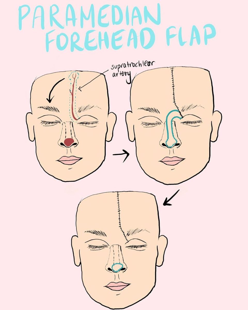 Paramedian Forehead Flap