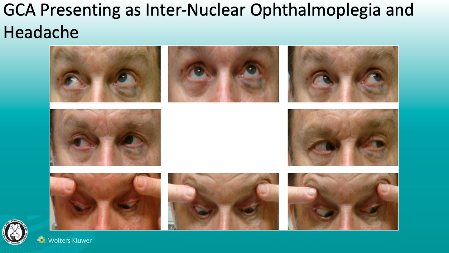 Internuclear Ophthalmoplegia