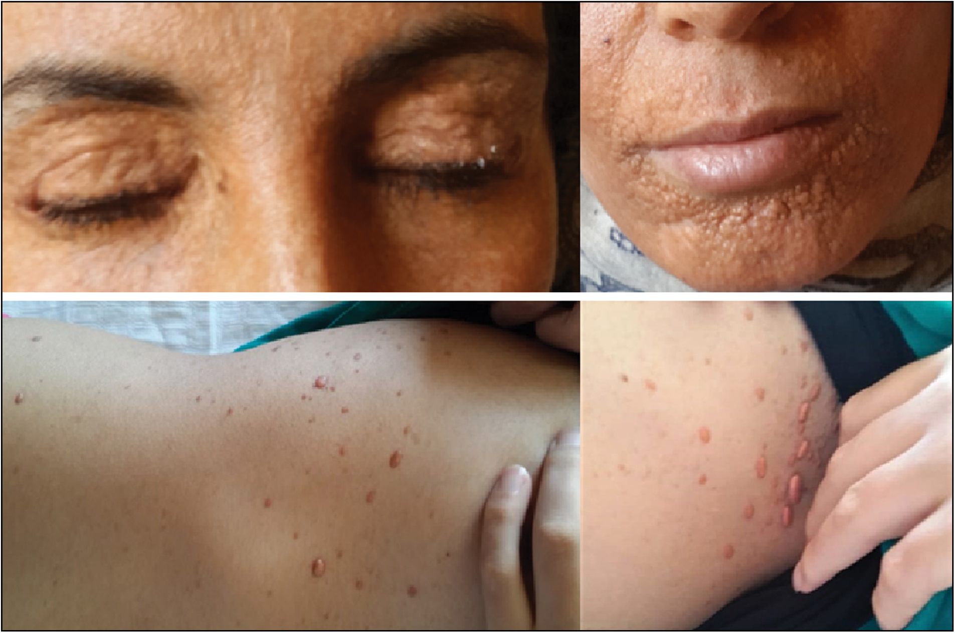 Xanthoma Disseminatum