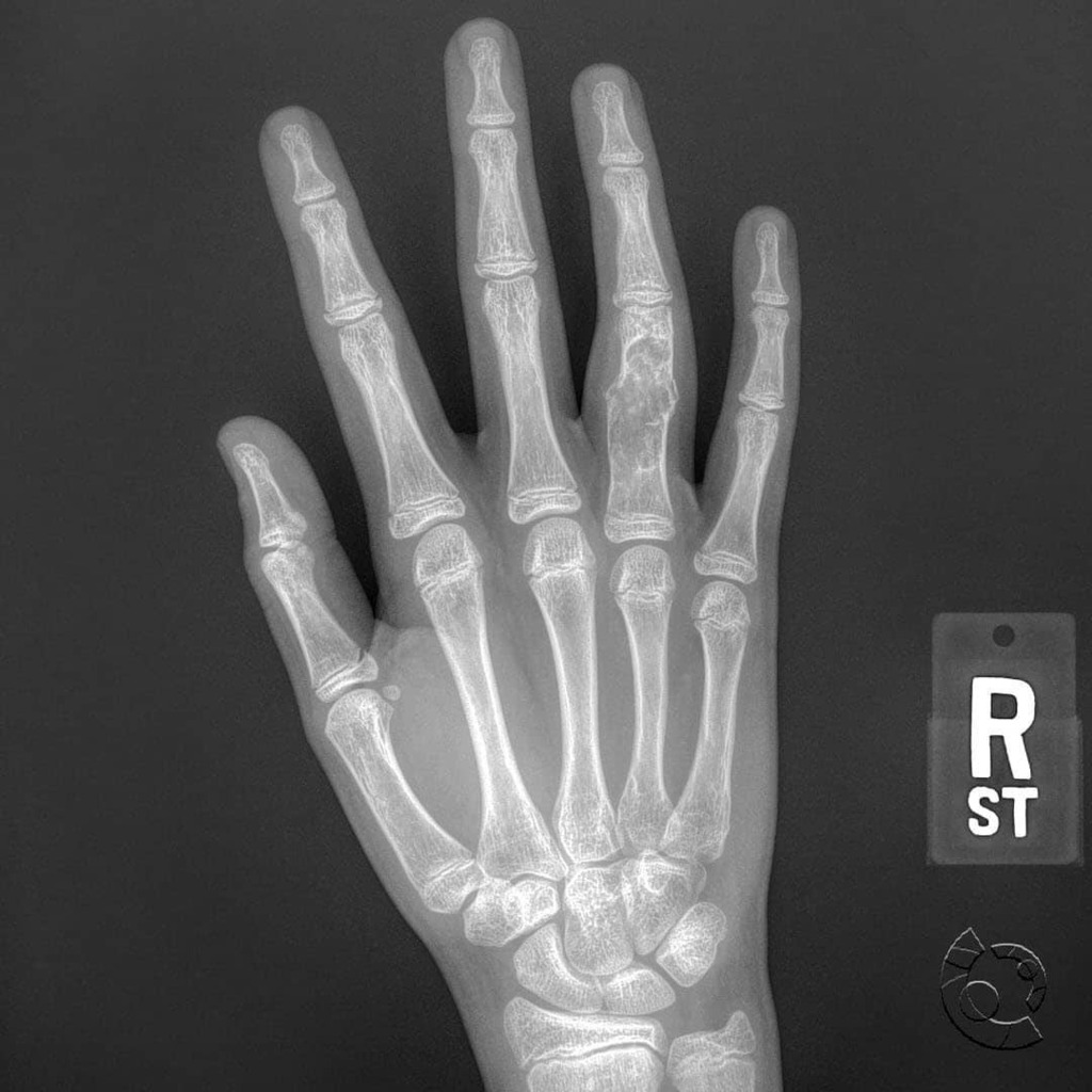 Enchondroma Hand