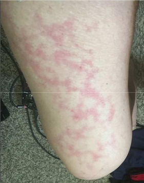 Mild Livedo Reticularis