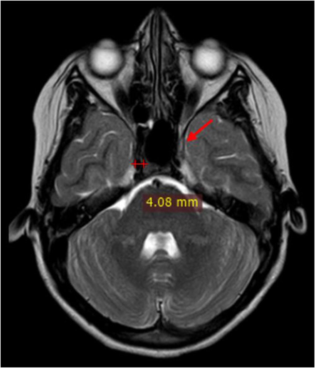 Cavernous Sinus Mri