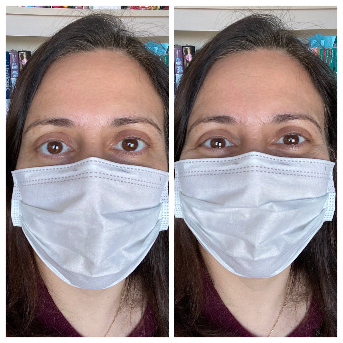 Orbicularis Oculi Smile