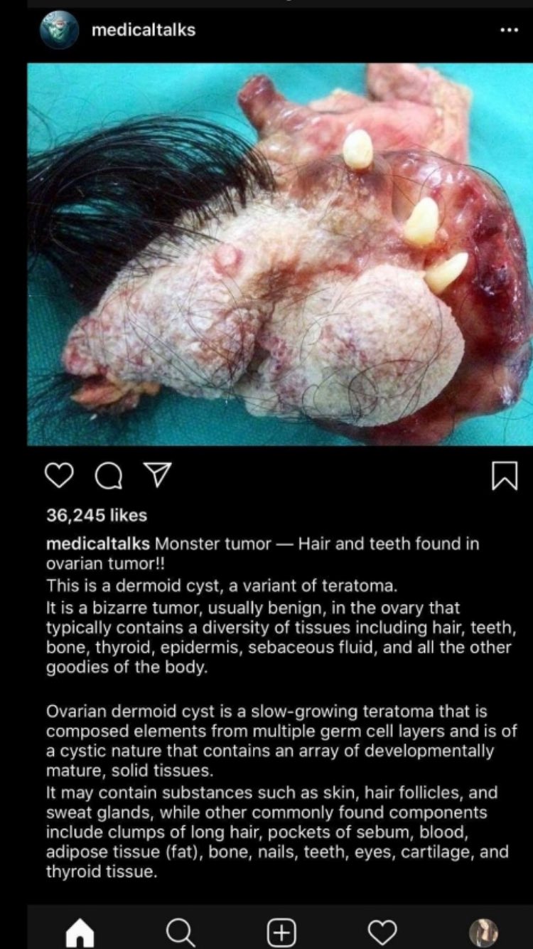 Ovarian Cyst With Eyes