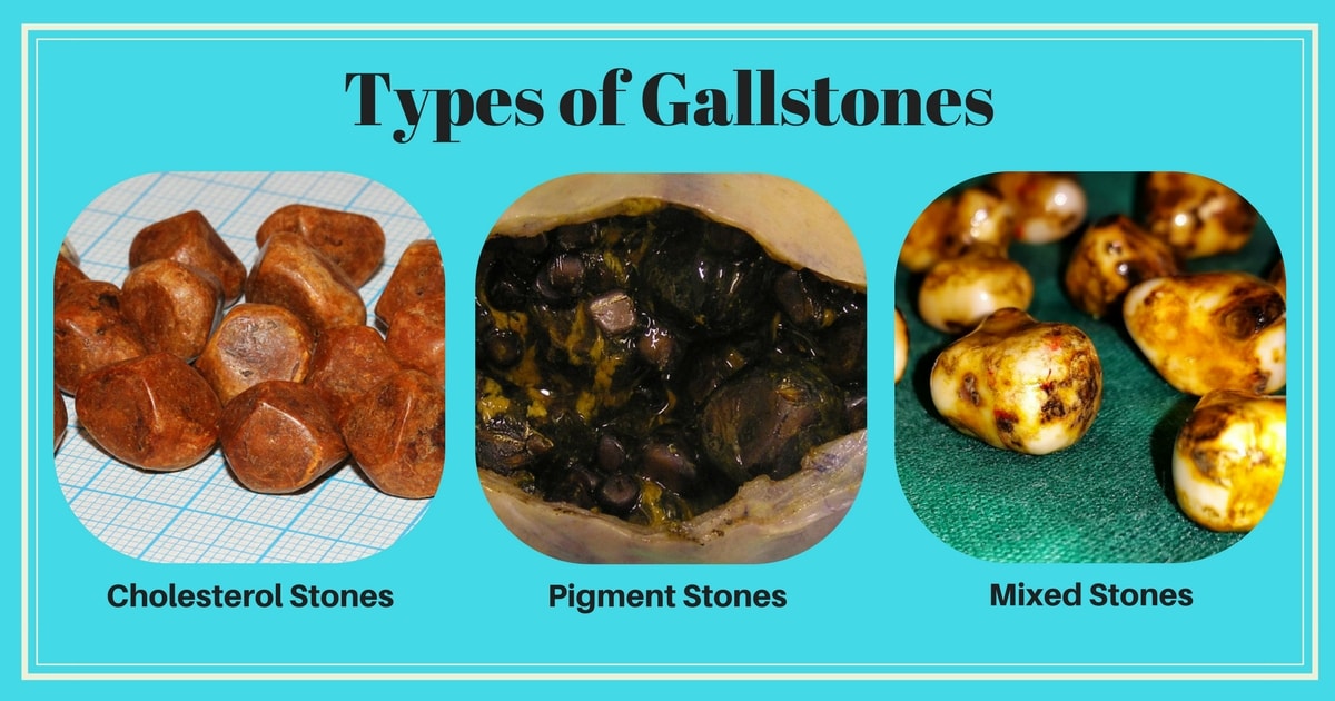 Brown Gallstones
