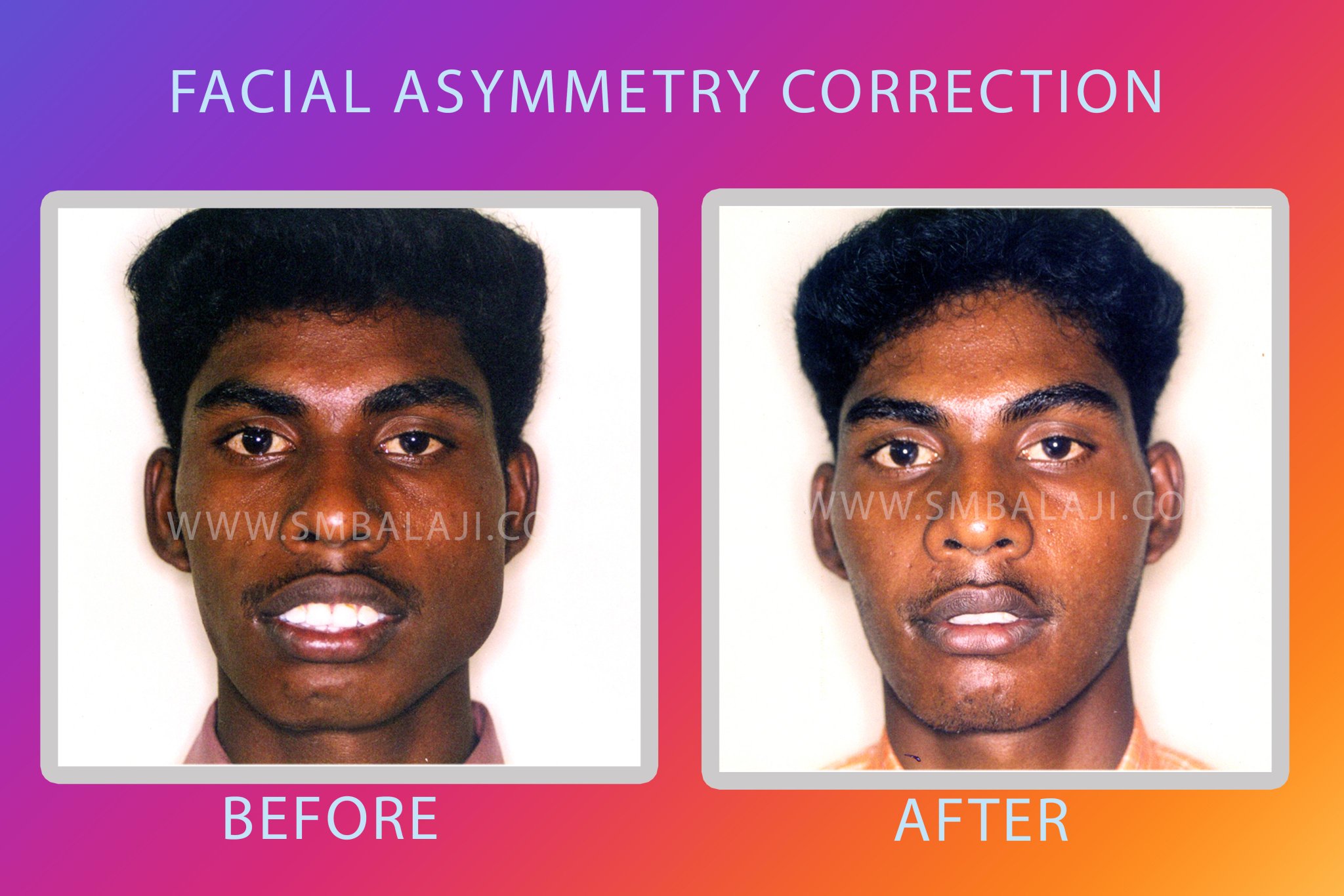 Asymmetrical Face Correction