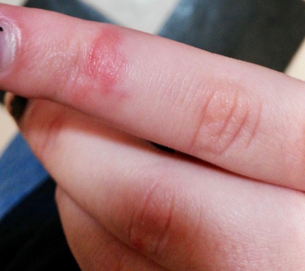 Lesions On Knuckles