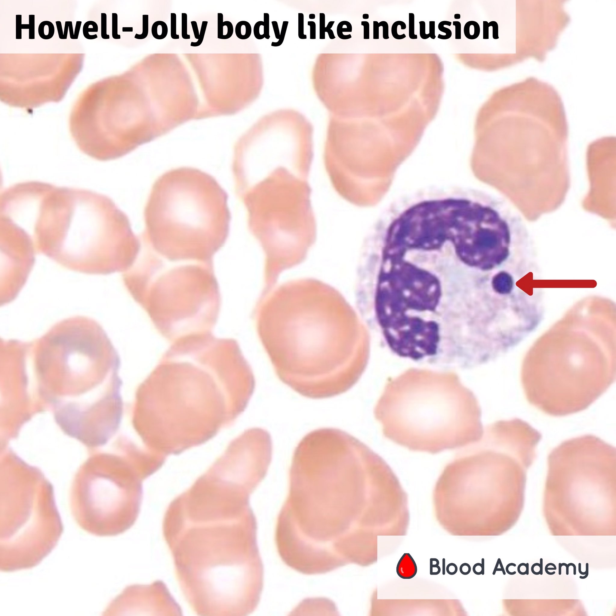 Wbc Inclusion Bodies