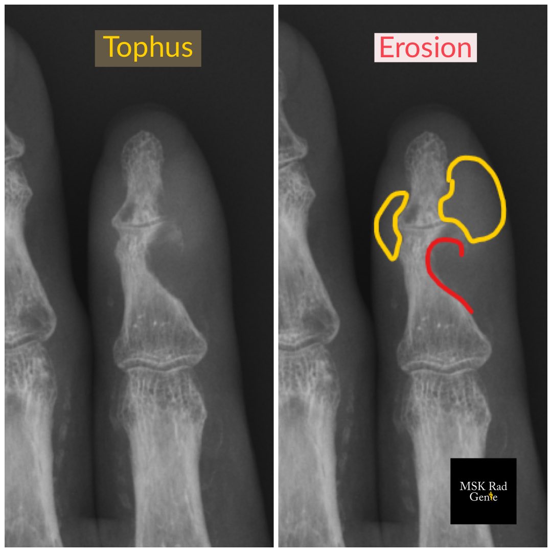 Tophus Xray