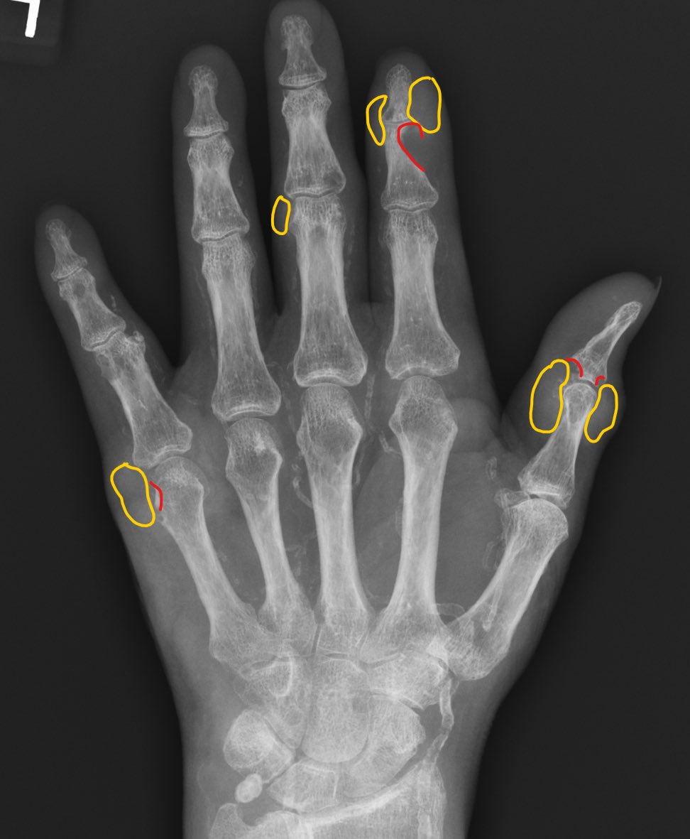 Gout Xray