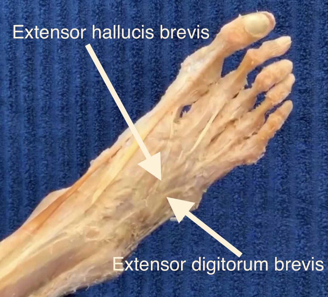 Extensor Hallucis Brevis Pain