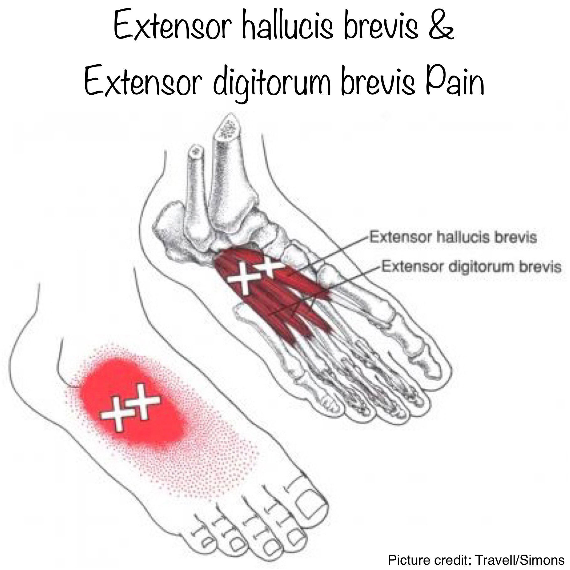 Foot Extensor Pain