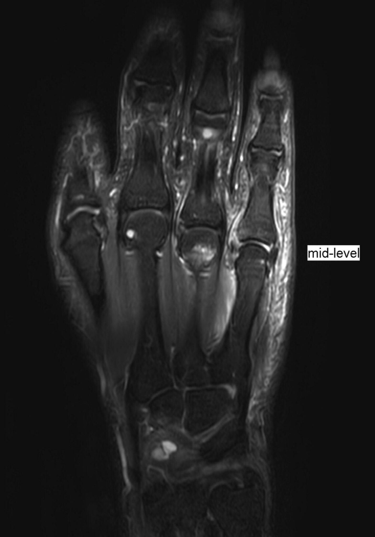 Flexor Digiti Minimi Mri