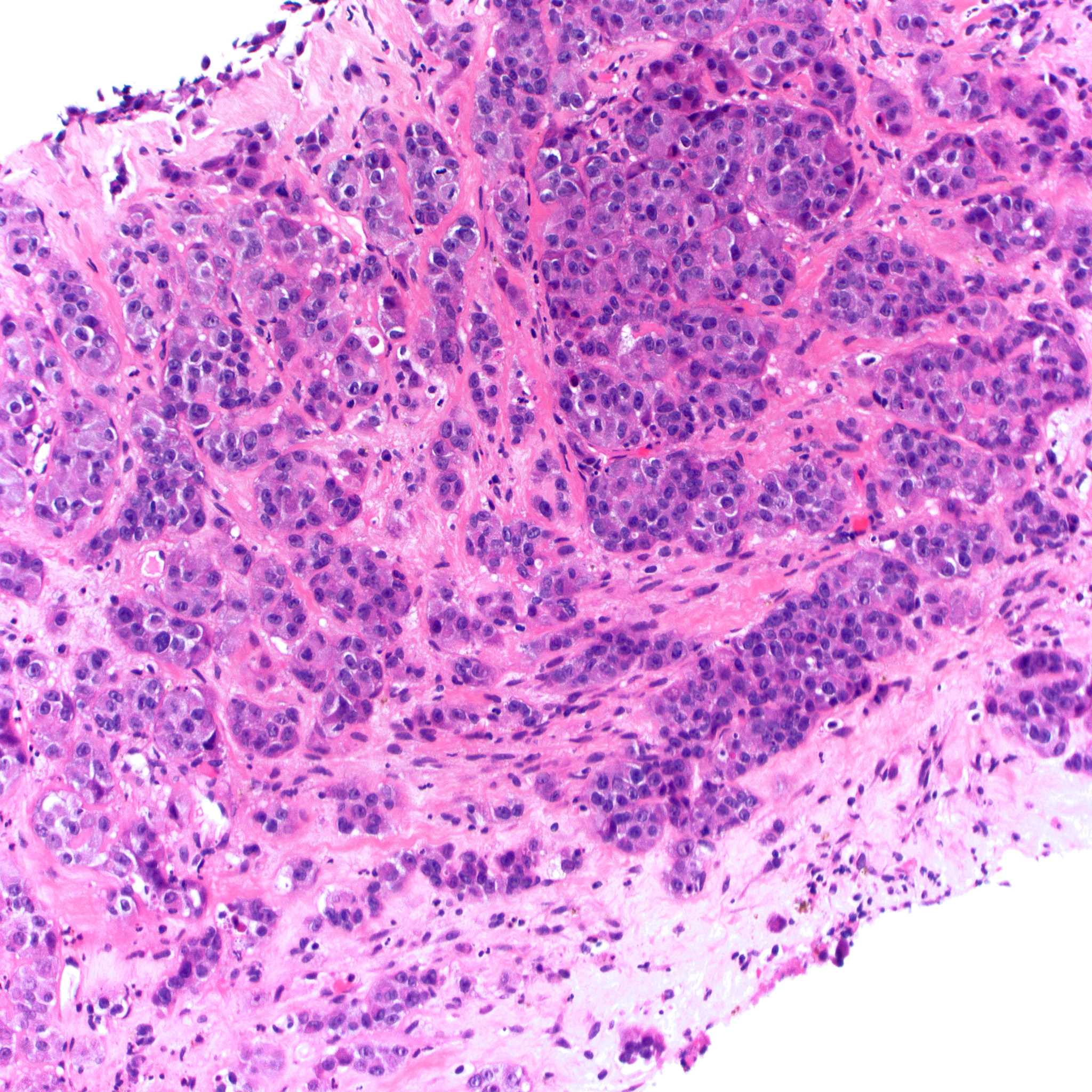 Angiosarcoma Histology