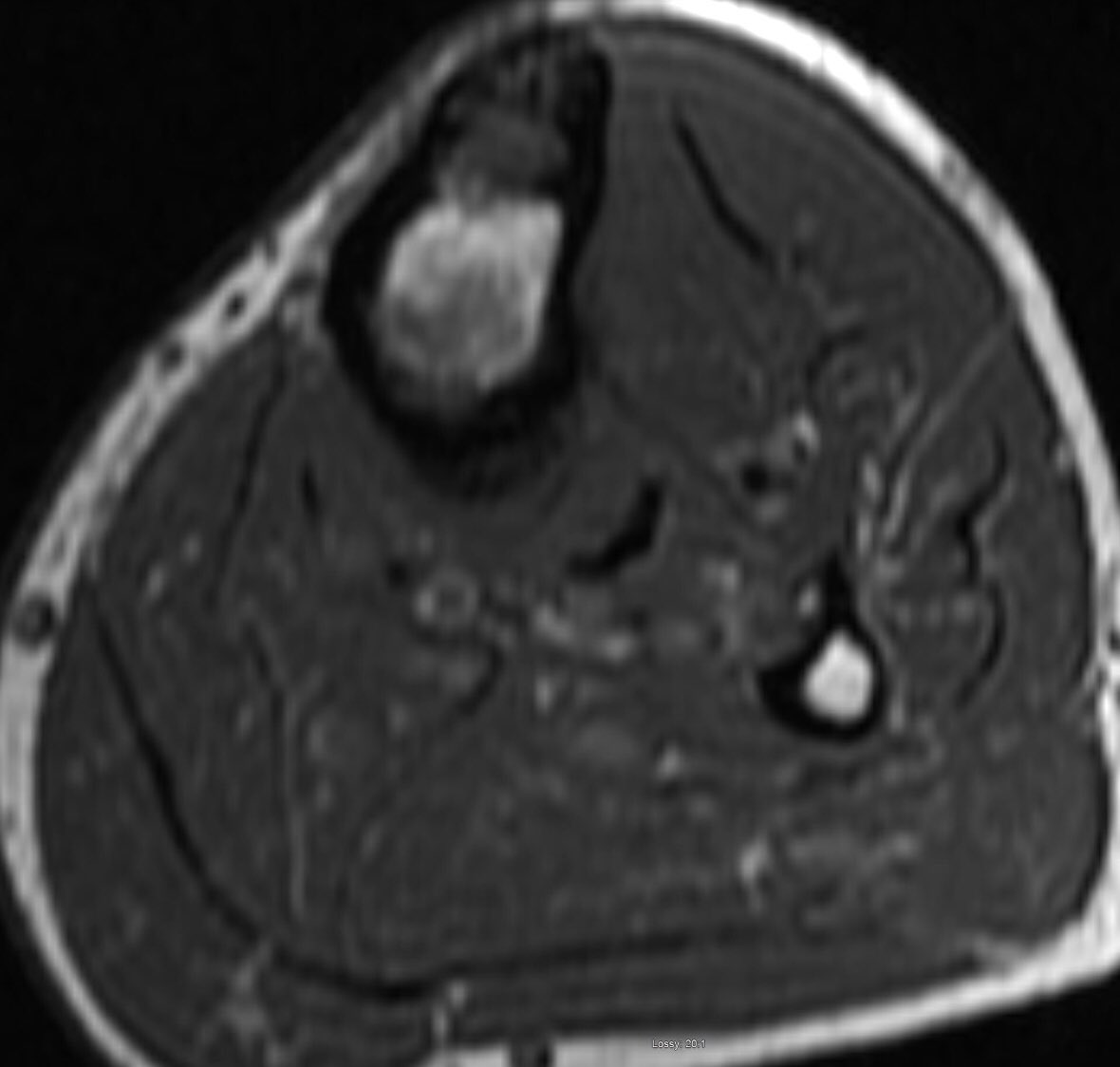 #msk #musculoskeletal #Radiology #MSK #orthopedics #orthotwitter Here a ...