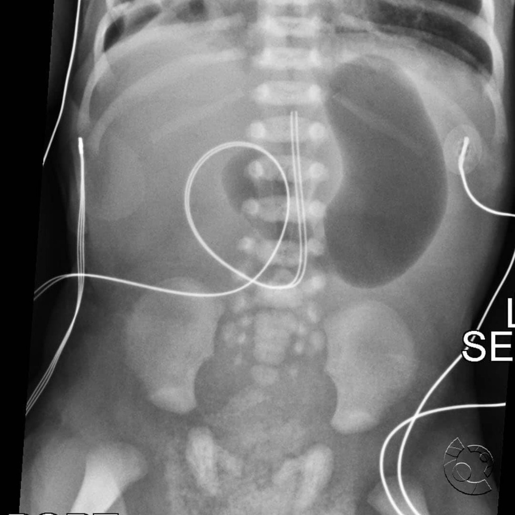 Annular Pancreas X Ray
