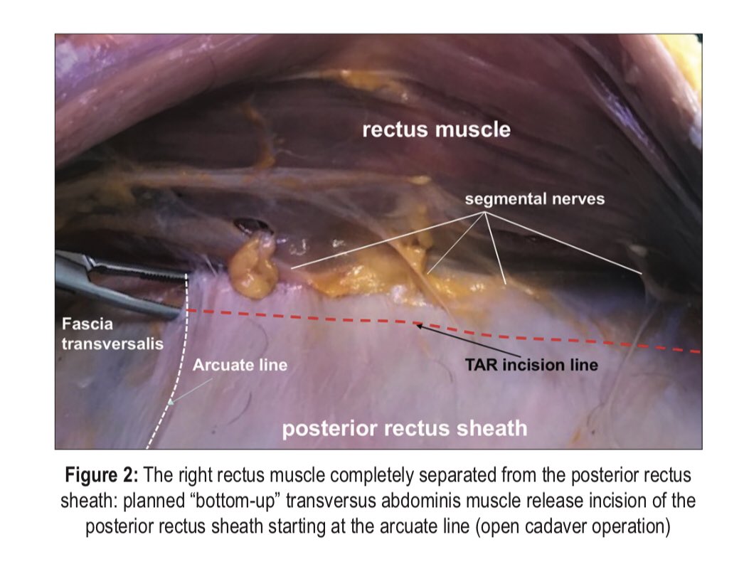 Arcuate Line Cadaver