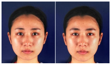 Masculine Face Testosterone