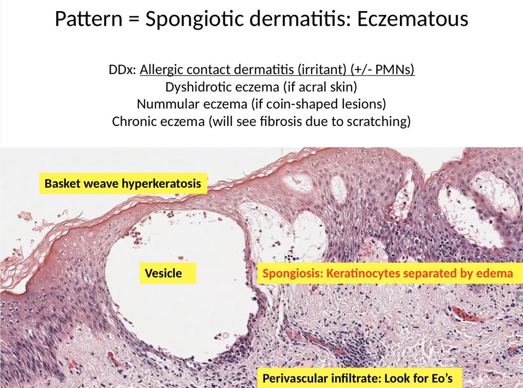 Eczematous Dermatitis Histopathology