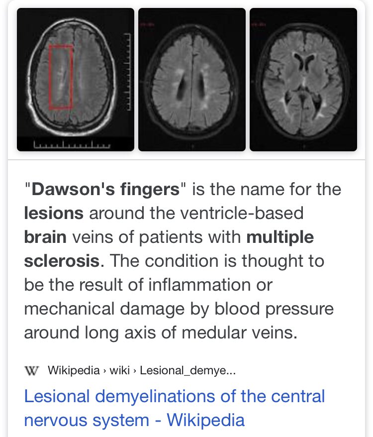 Multiple Sclerosis Mri Dawsons Fingers