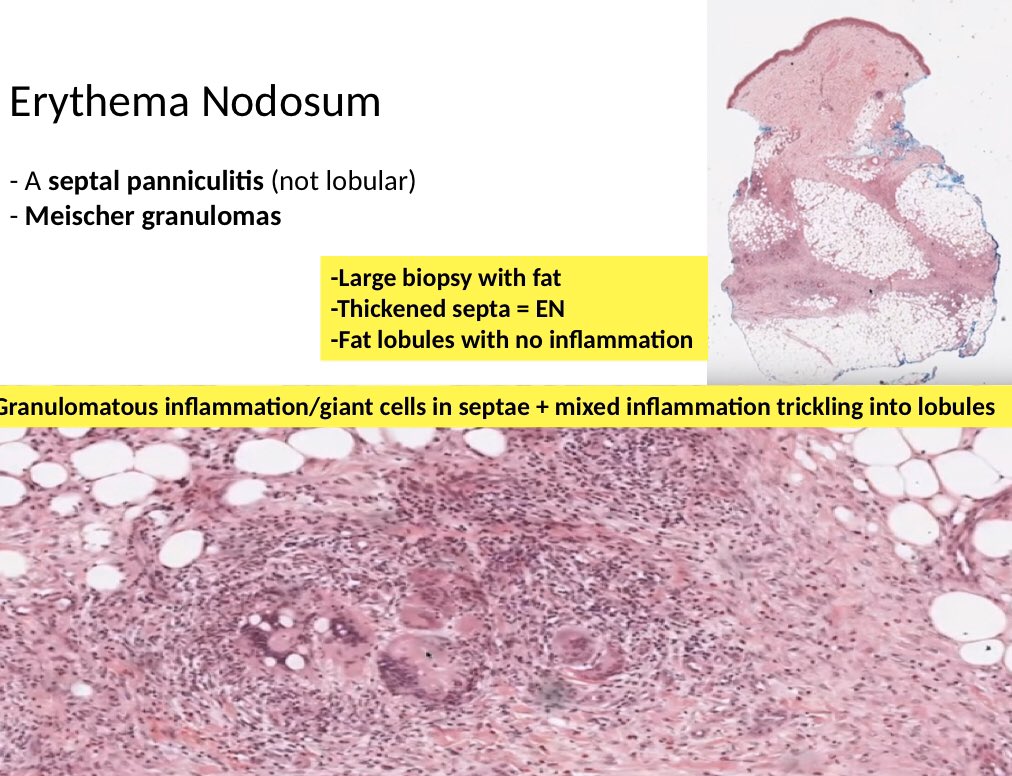 Erythema Nodosum Histology