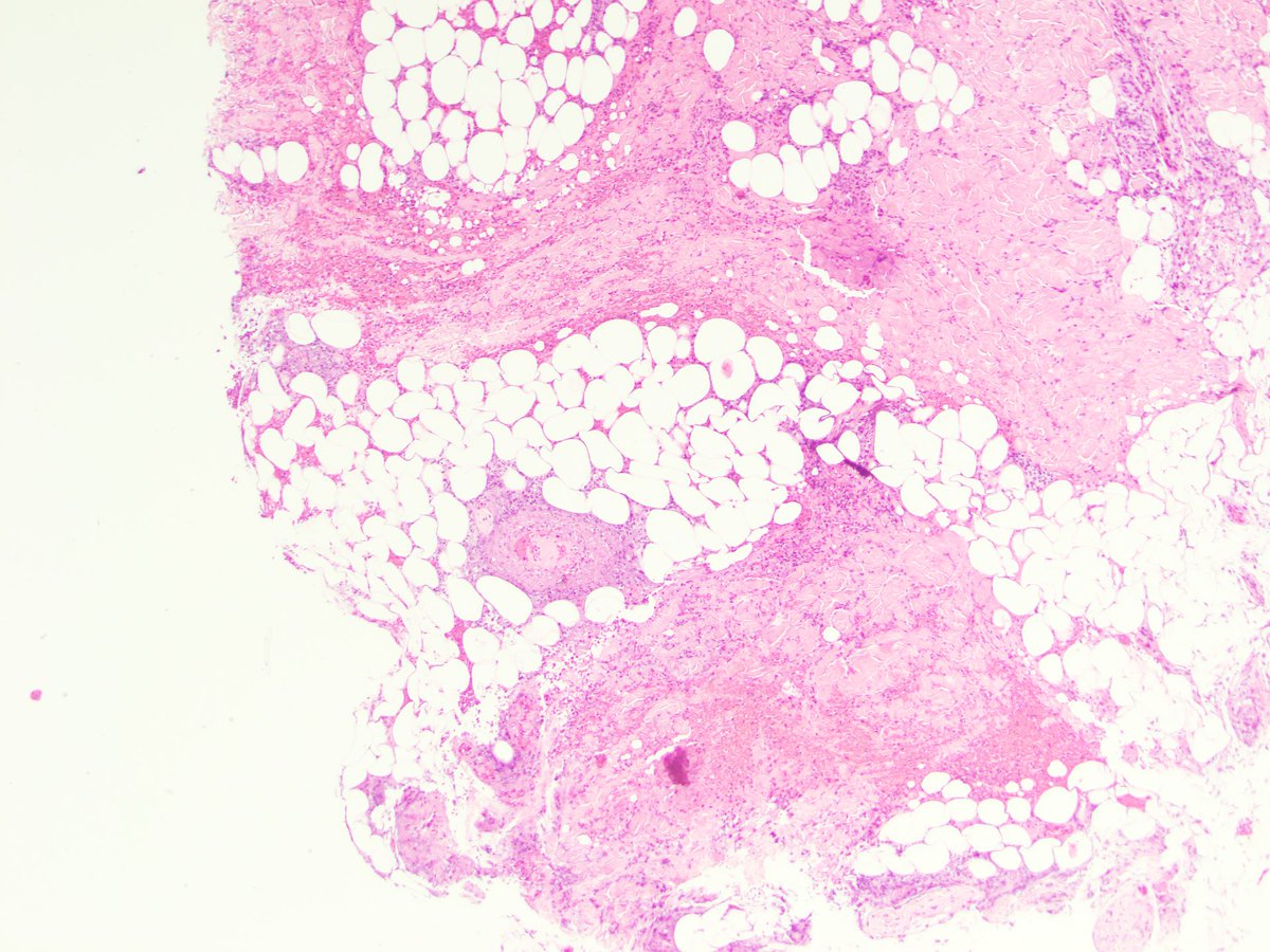 Erythemainduratumnodularvasculitis
