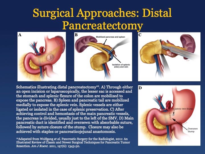 Distal Pancreatectomy